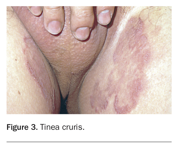 Overview of cutaneous fungal infections Medicine Today